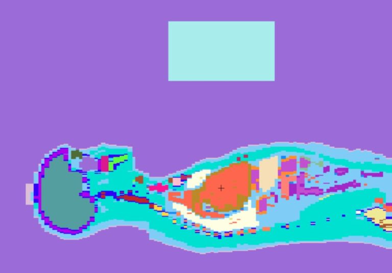 HEAD AND NECK DOSES FROM ADVANCED CARDIAC AND INTERVENTIONAL RADIOLOGY ...